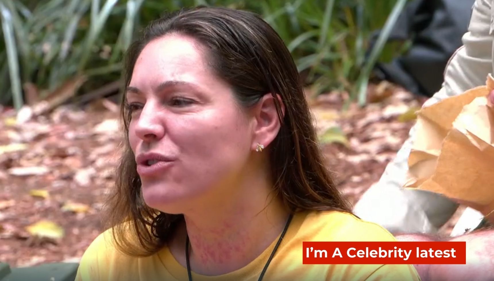 I'm A Celebrity star Kelly Brook sparks concern with neck rash